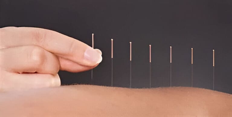 Acupuncture | Acupuncture Therapy by Medical Massage Clinic